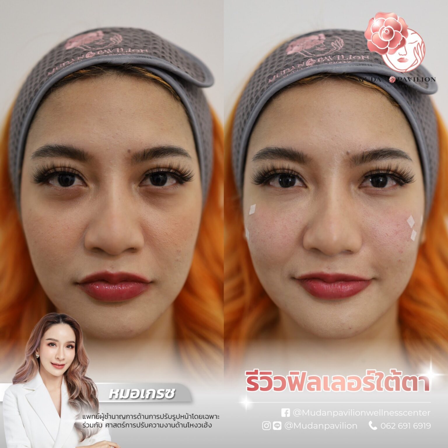 What causes sunken eyes and deep eye sockets? And how to fix them in ...